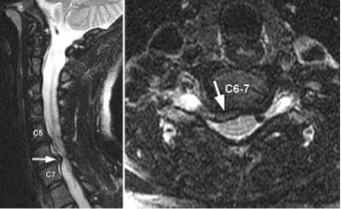 Κήλη Μεσοσπονδύλιου Δίσκου - drlykissas.com